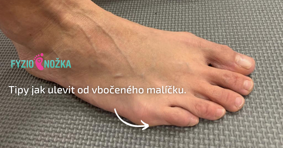 Jak si pomoci od vbočeného malíčku? | Fyzionožka